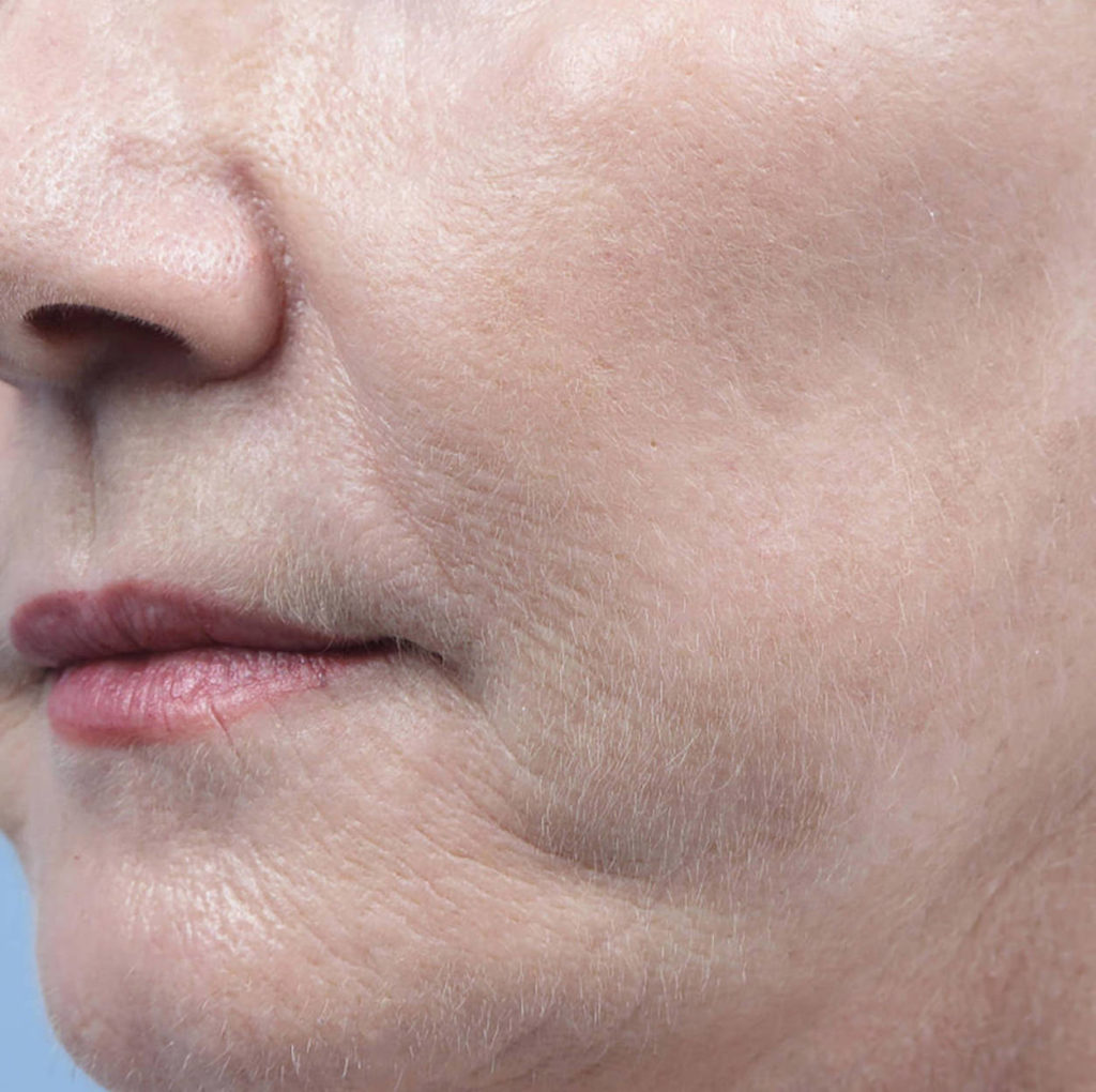 Fractora Radiofrequency Microneedling | St. Catharines, Niagara ...